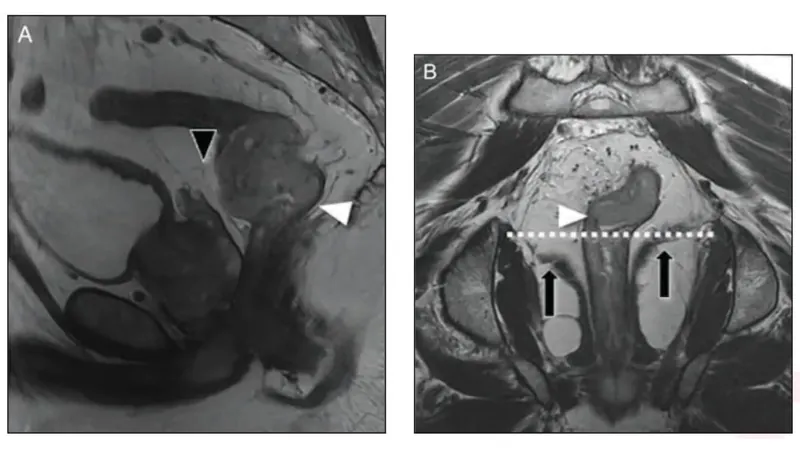 7 claves de MRI en el Cáncer de Recto: Nuevas evidencias en la ...
