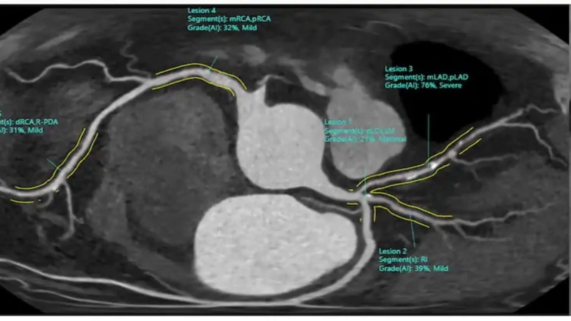 IA en angiotomografía coronaria para descartar enfermedad obstructiva ...