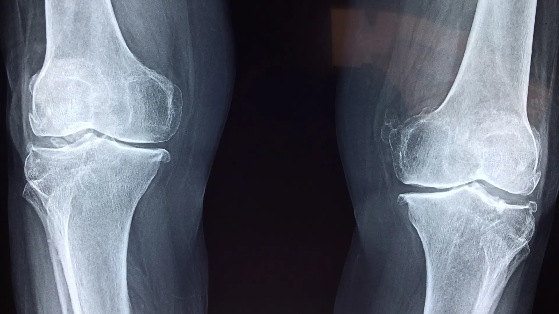 Embolización arterial genicular y artrosis de rodilla - RadiologiaLatam