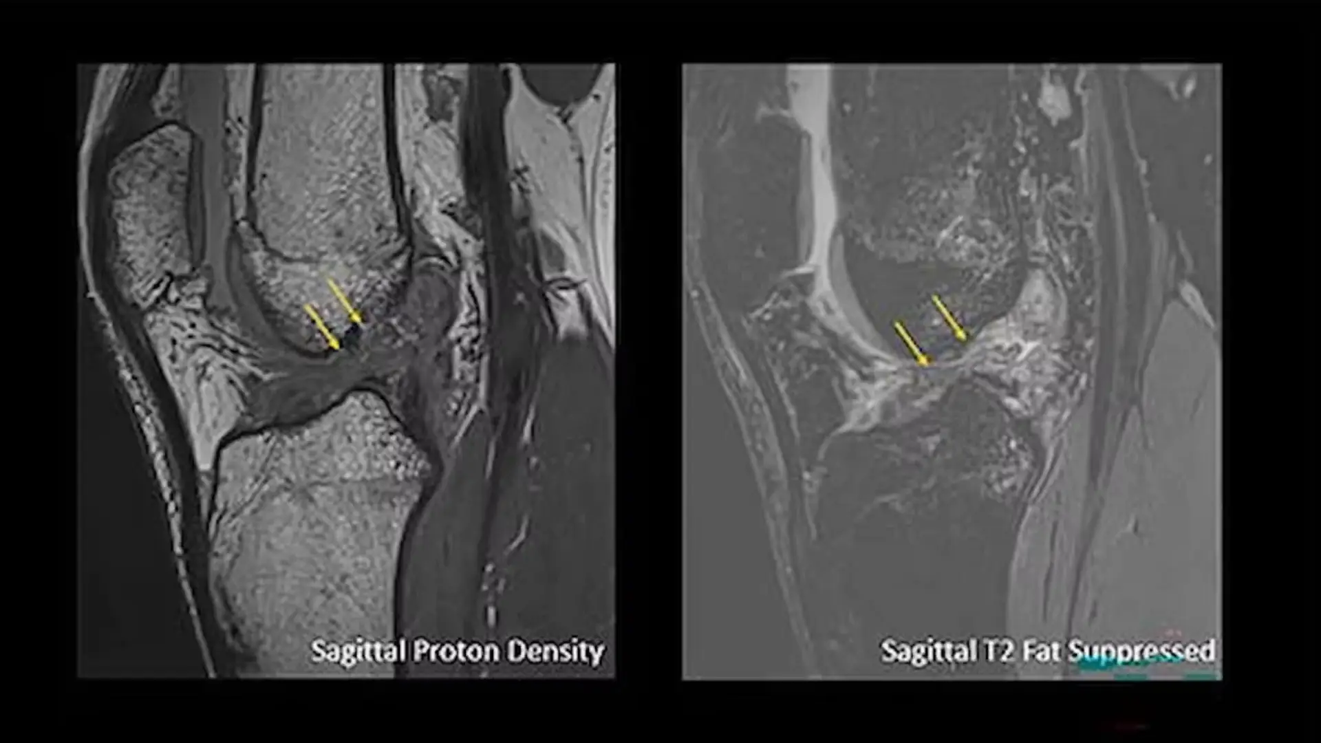 RSNA 2025: Gran estudio de RM de rodilla revela mayor incidencia de ...